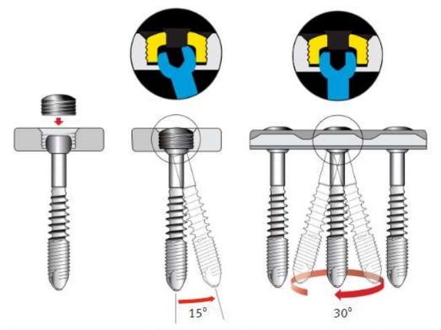 SCREWS in orthopaedic surgery.pptx | Needlework | Arts and Crafts