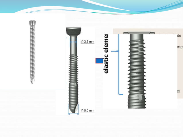 SCREWS in orthopaedic surgery.pptx | Needlework | Arts and Crafts
