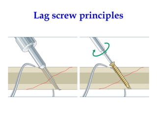 Screws and plates fixation | PPT