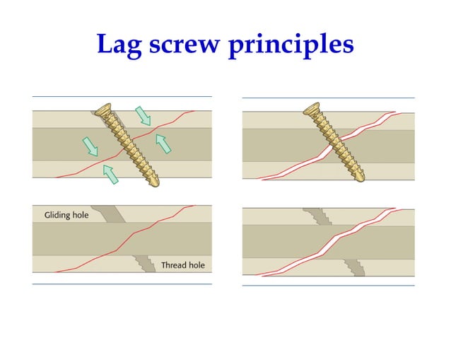 Screws and plates fixation | PPT | Death, Injury, or Military Conflict ...