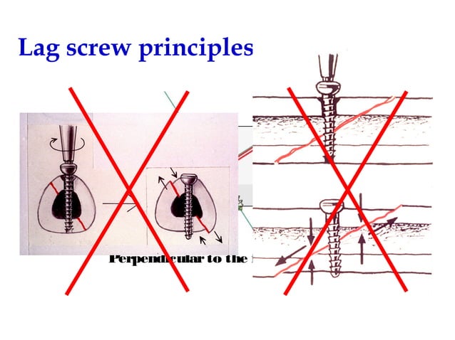 Screws and plates fixation | PPT | Death, Injury, or Military Conflict ...