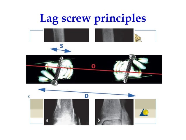 Screws and plates fixation | PPT | Death, Injury, or Military Conflict ...