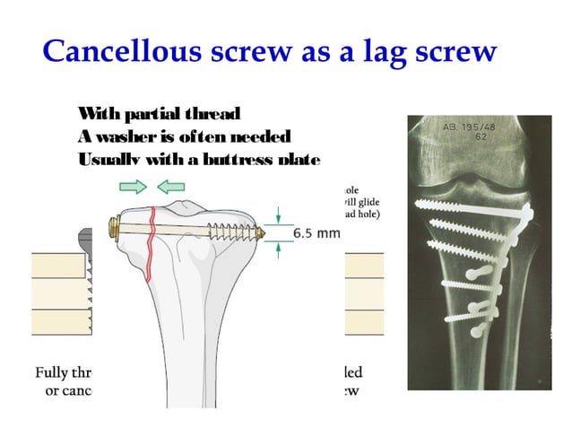 Screws and plates fixation | PPT