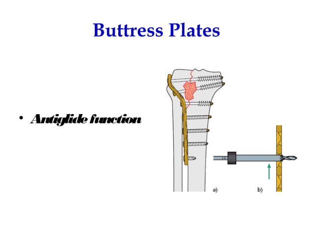 Screws and plates fixation | PPT | Death, Injury, or Military Conflict ...