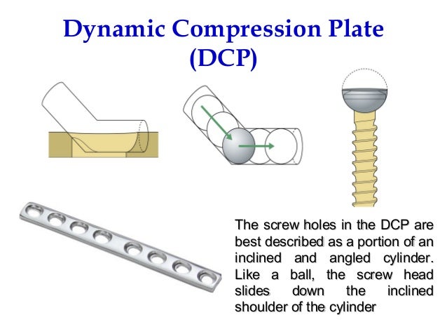 Screws and plates fixation