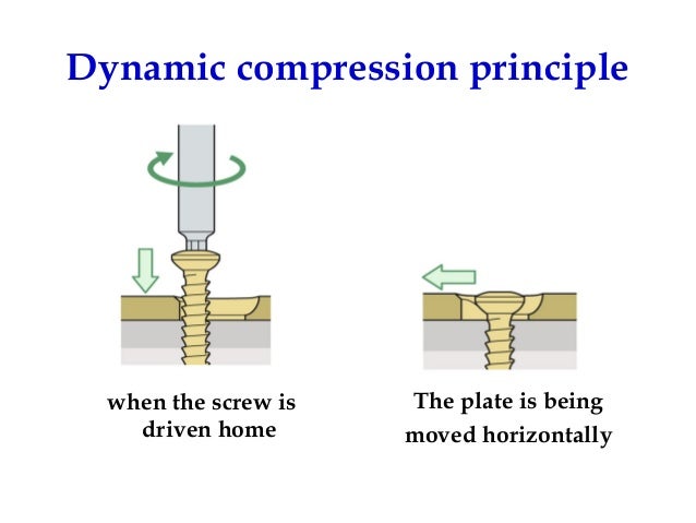Screws and plates fixation