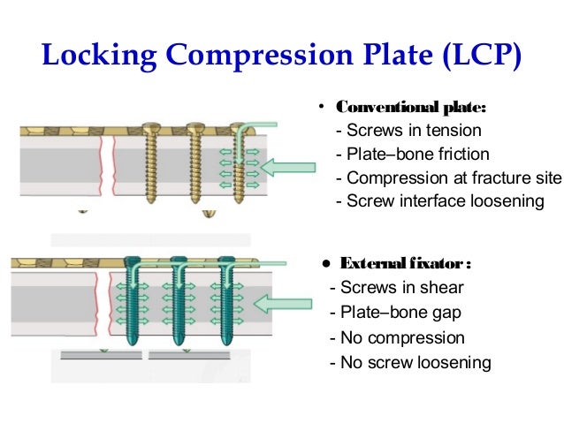 Screws and plates fixation