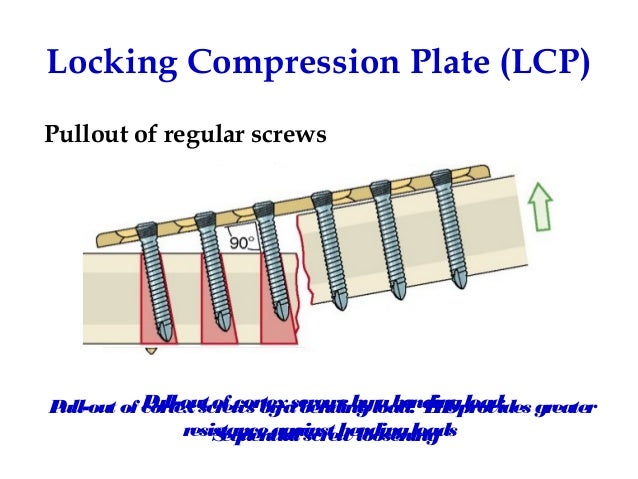 Screws and plates fixation