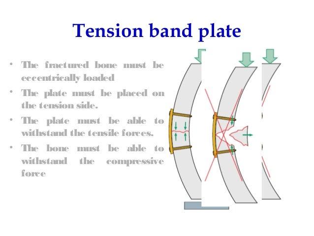 Screws and plates fixation