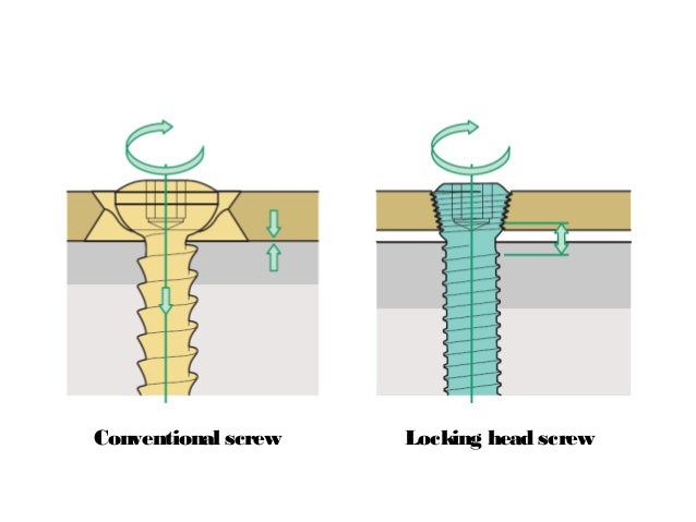 Screws and plates fixation