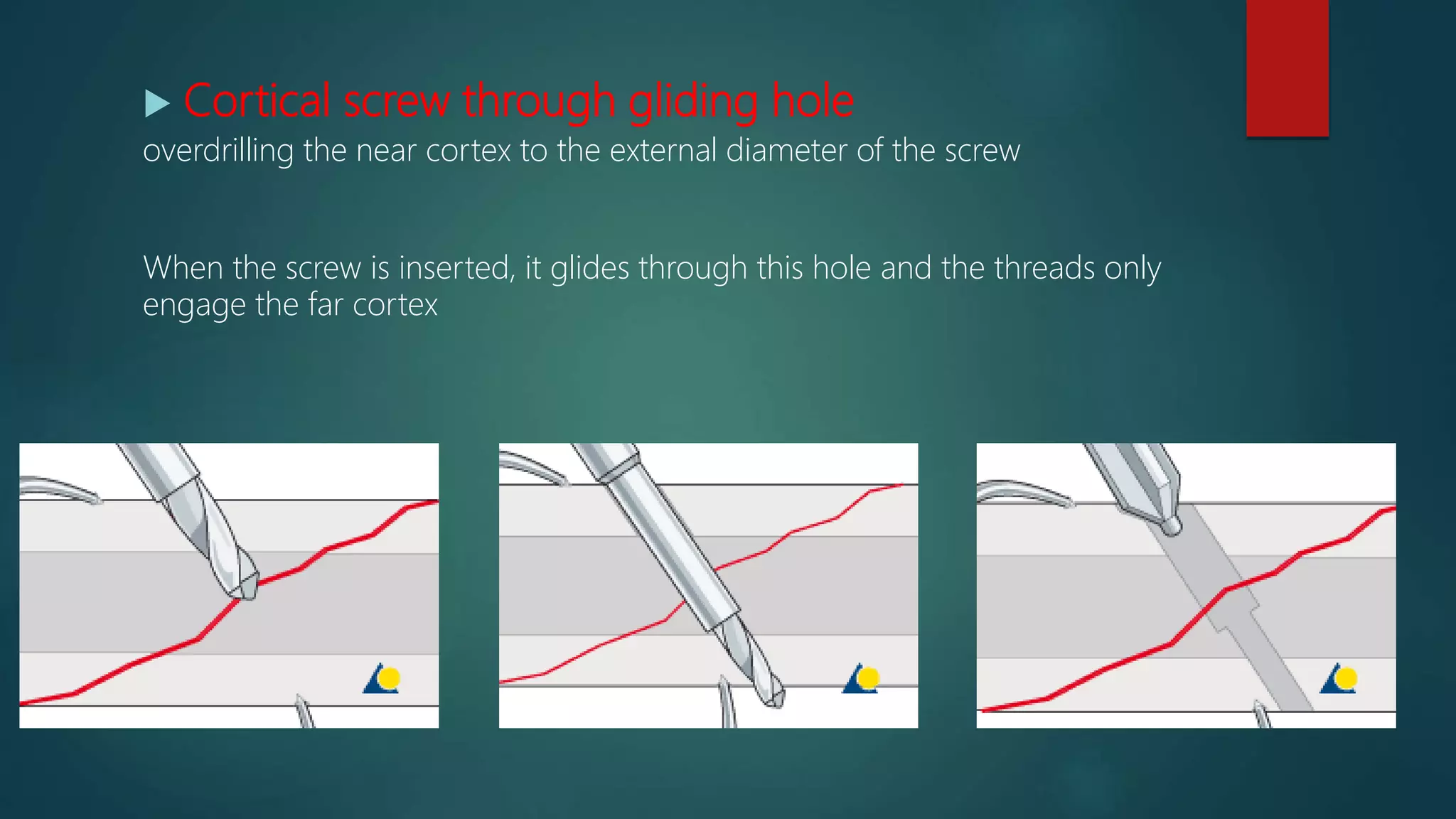 Basics of Screws in Orthopedics | PPTX