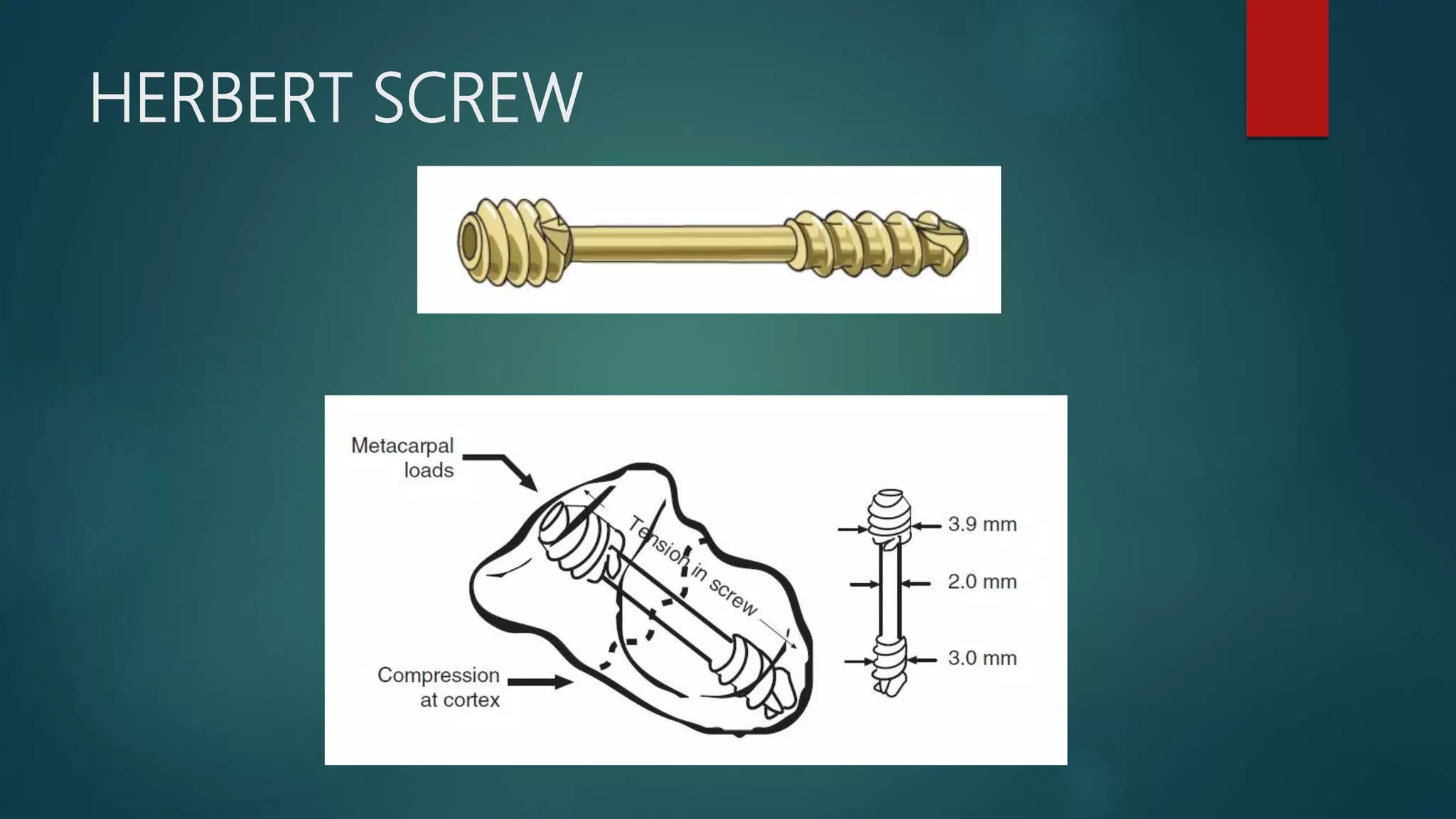 Basics of Screws in Orthopedics | PPTX