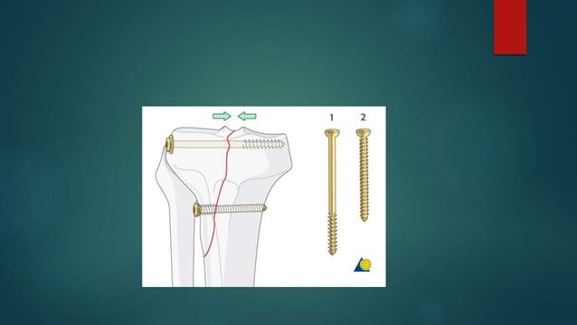 Basics of Screws in Orthopedics | PPTX