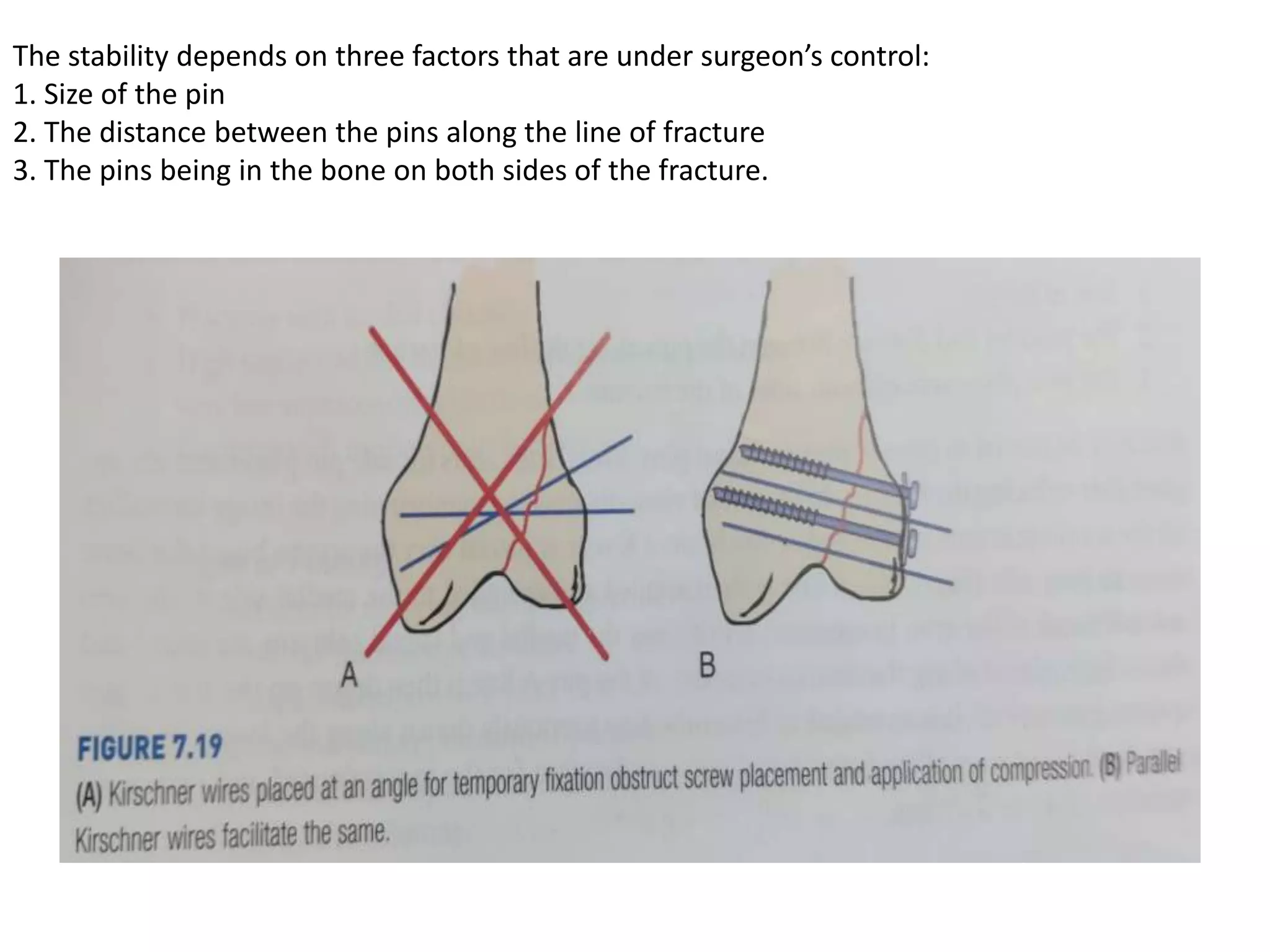 SCREWS,WIRES,PINS ORTHOPEDICS .pptx