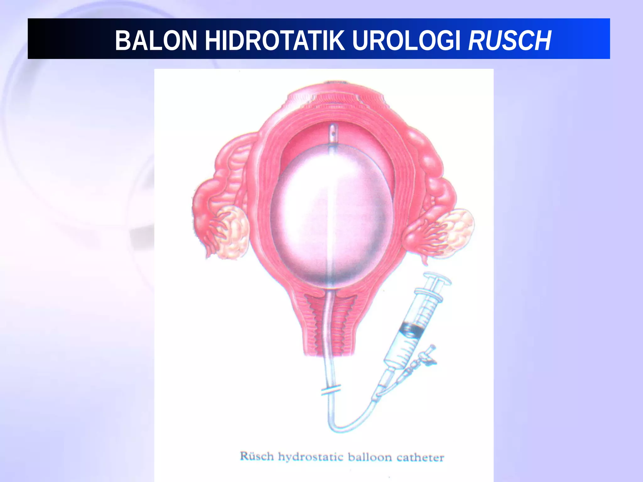 scribfree.com_ob-emg-balon-kateter.pdf