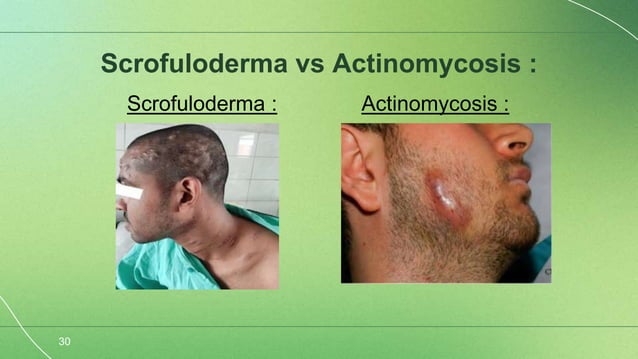 Scrofuloderma semi final-1.pptx | Skin and Dermatology | Diseases and ...