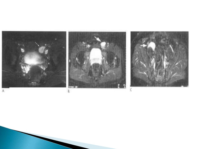 Scrotal disorders | PPTX