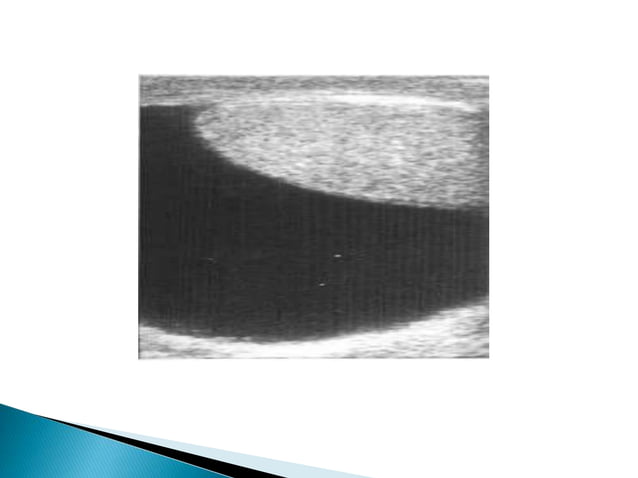 Scrotal disorders | PPTX