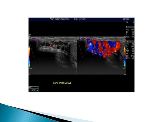 Scrotal disorders | PPTX