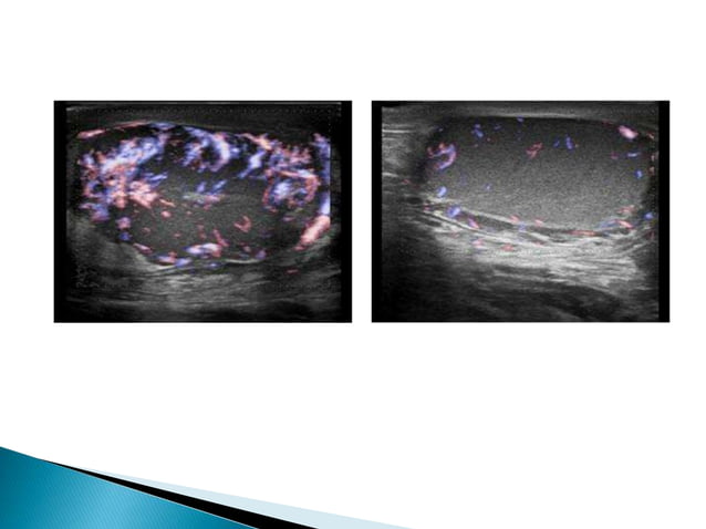 Scrotal disorders | PPTX