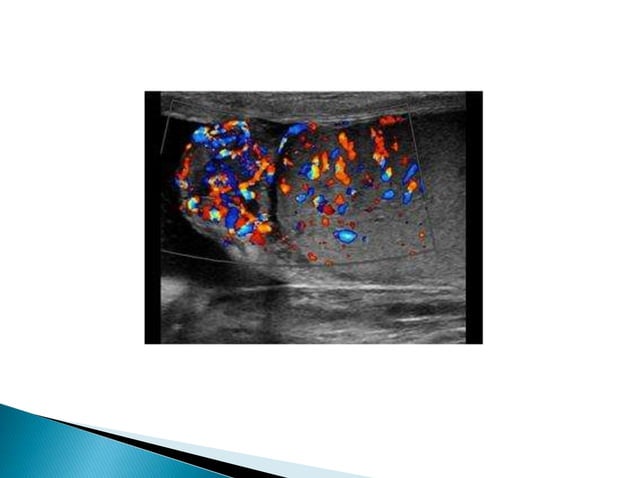Scrotal disorders | PPTX