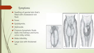 Scrotal filariasis | PPTX