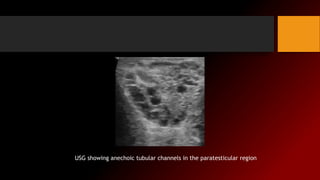 Radiological Findings in Scrotal Filariasis - A Case Series | PPTX
