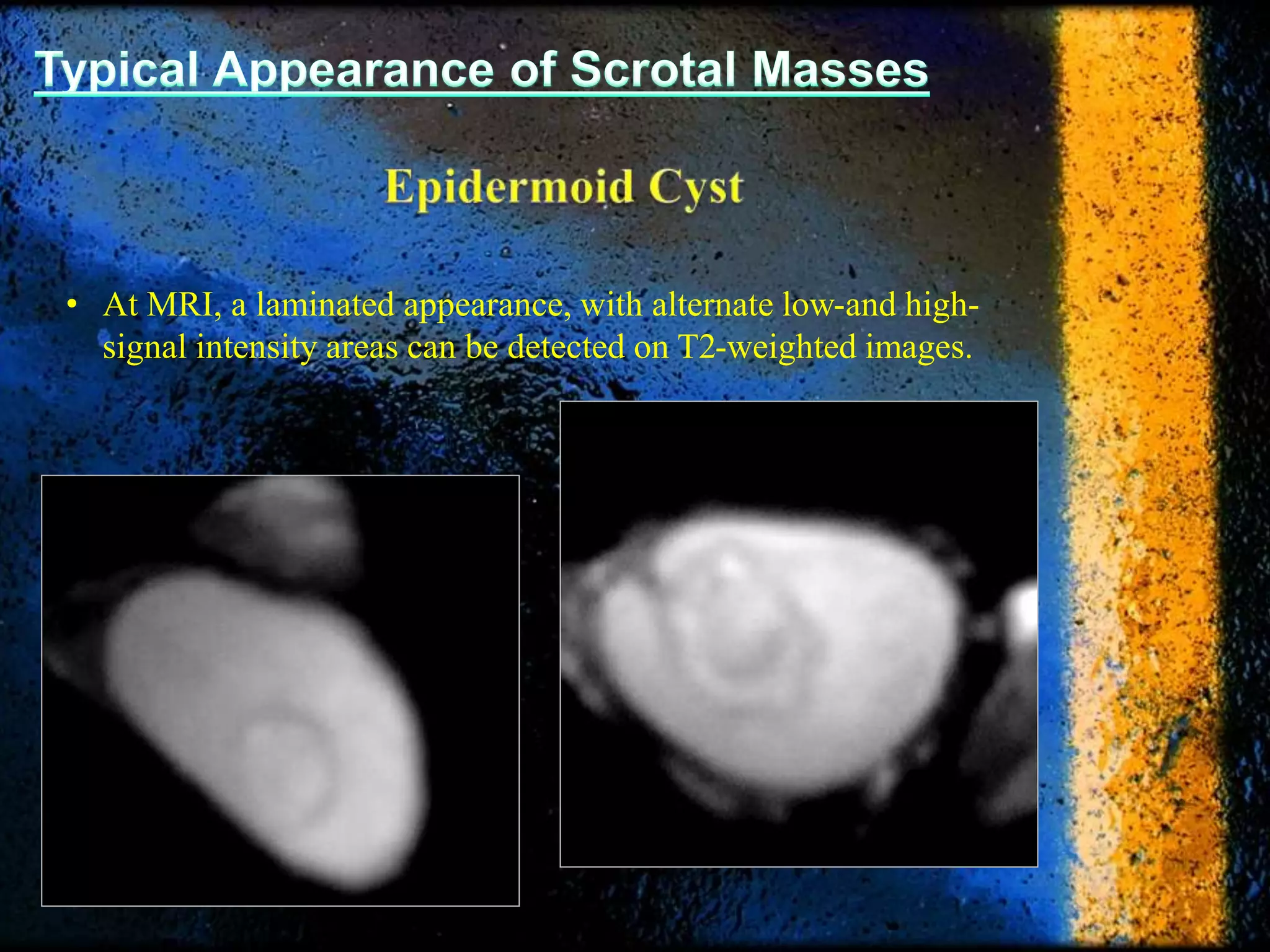 Scrotal masses | PPTX