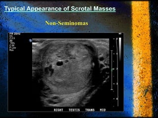 Scrotal masses | PPTX
