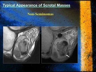 Scrotal masses | PPTX