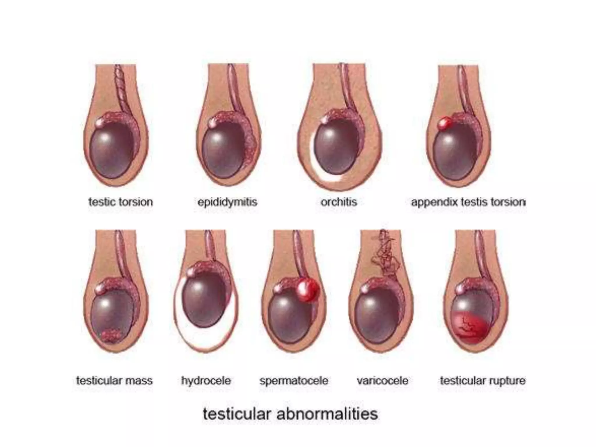 SCROTAL SWELLING | PPTX | Reproductive Health | Diseases and Conditions