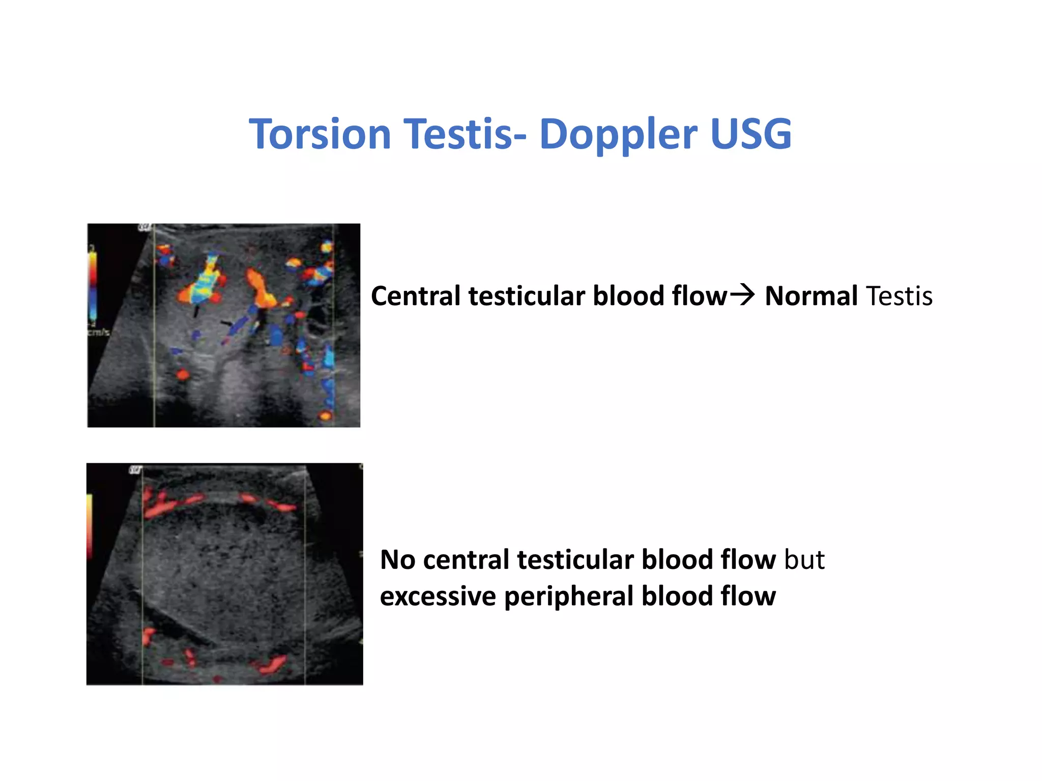 SCROTAL SWELLING | PPTX