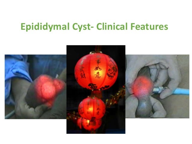 Chinese Lantern Pattern On Transillumination