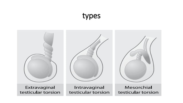 scrotal swelling common causes of scrotal | PPTX | Reproductive Health ...