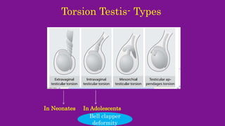 Scrotal swellings 2- Torsion Testis | PPTX
