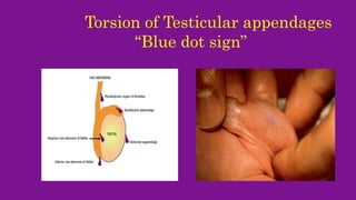 Torsion Of Appendix Testis Blue Dot Sign