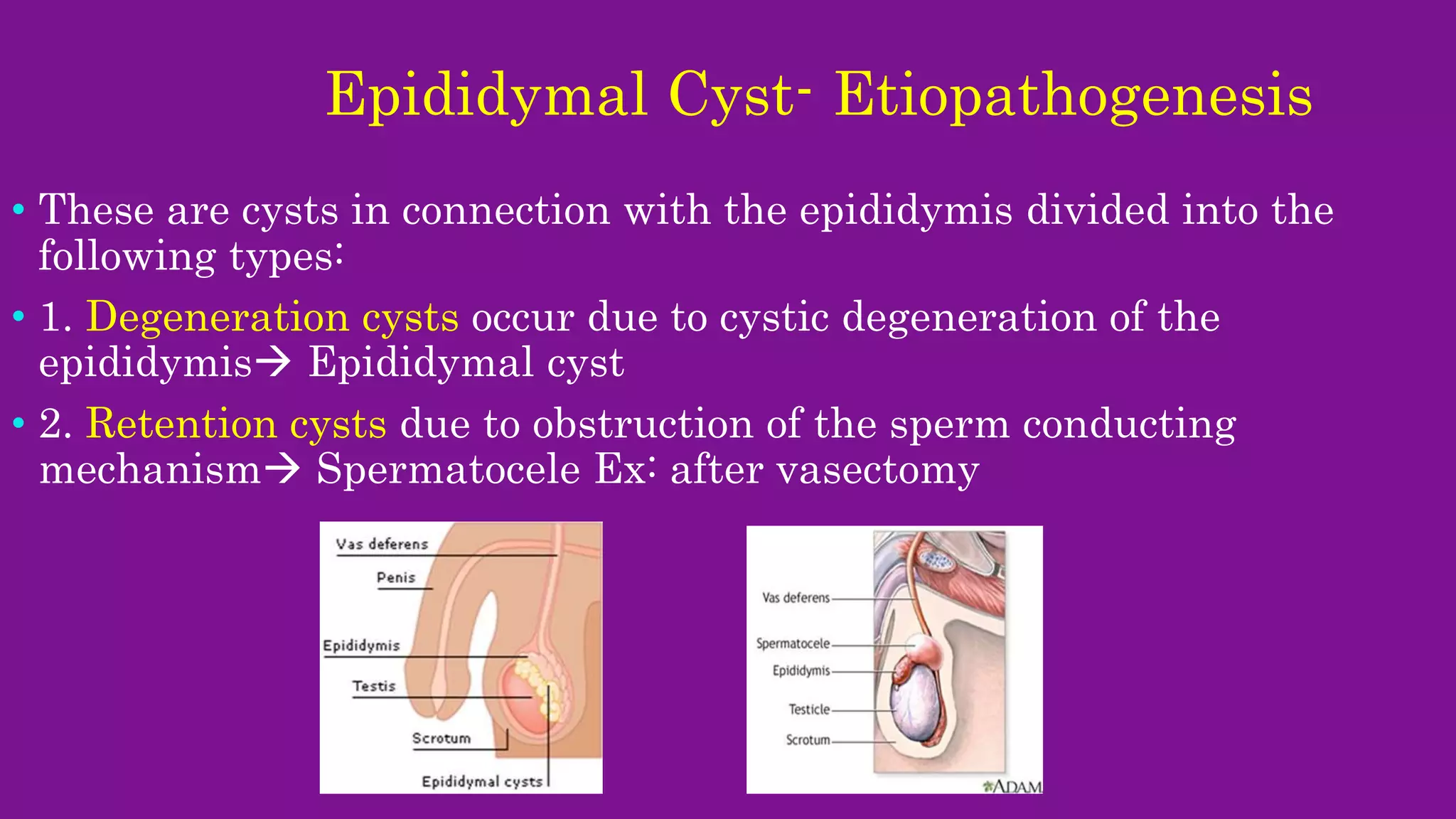 Scrotal swellings 3- Epididymal cyst | PPTX
