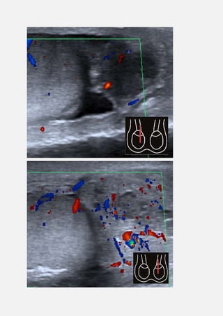 Scrotal ultrasound | DOCX