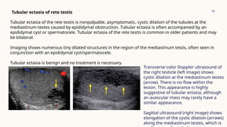 Scrotal ultrasound- By Dr Nishant Mishra .pptx