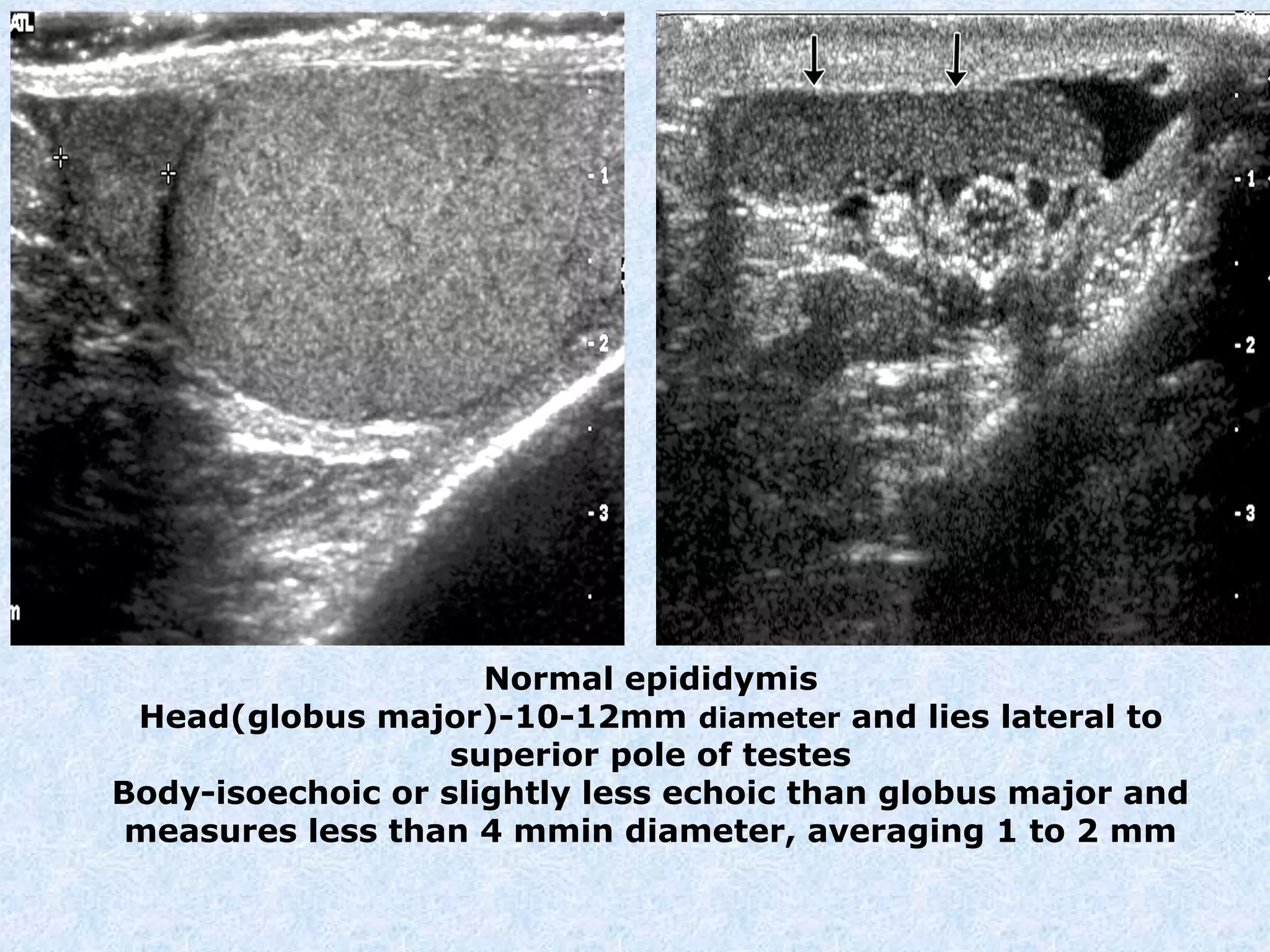 Scrotum imaging | PPT