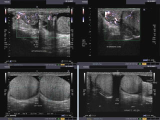 Scrotum imaging | PPT