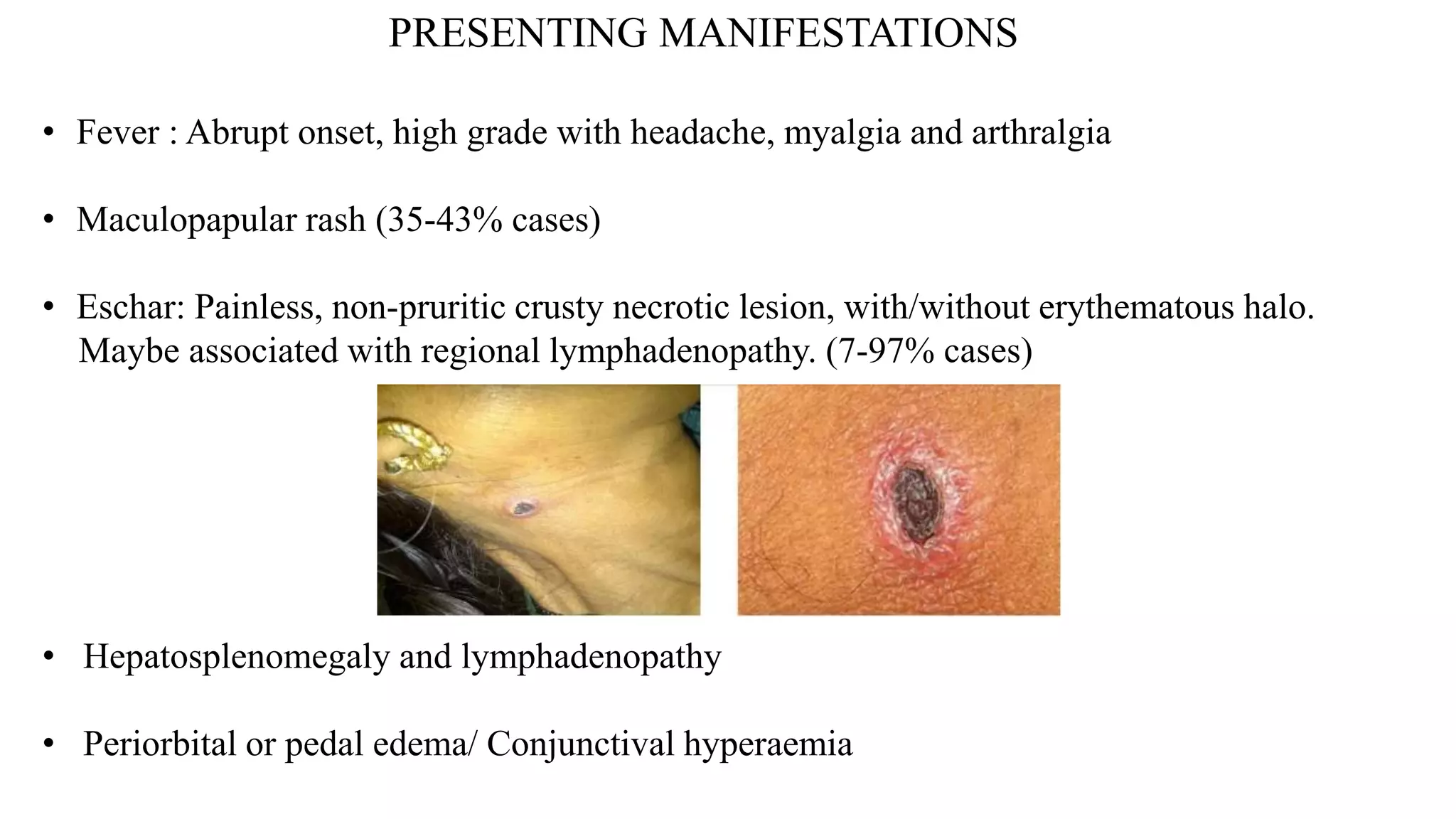 Scrub typhus in India | PPT