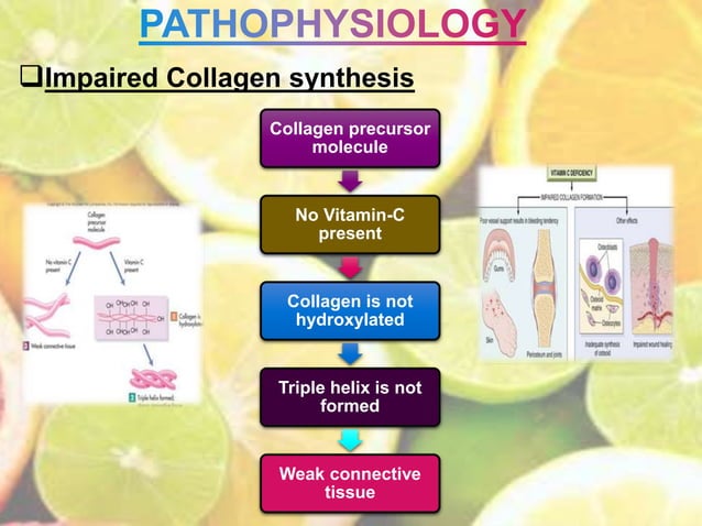 Vitamin-C deficiency disease Scurvy. | PPTX