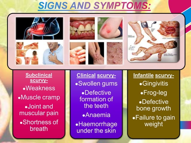 Vitamin-C deficiency disease Scurvy. | PPTX