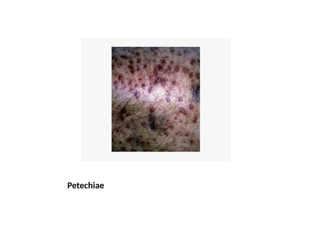 Disease caused by vitamin c Scurvy.pptx