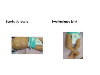 Disease caused by vitamin c Scurvy.pptx