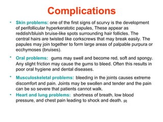 Scurvy Disease | PPT