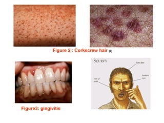 Scurvy Disease | PPT