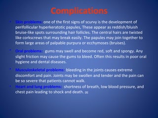 Scurvy | PPT