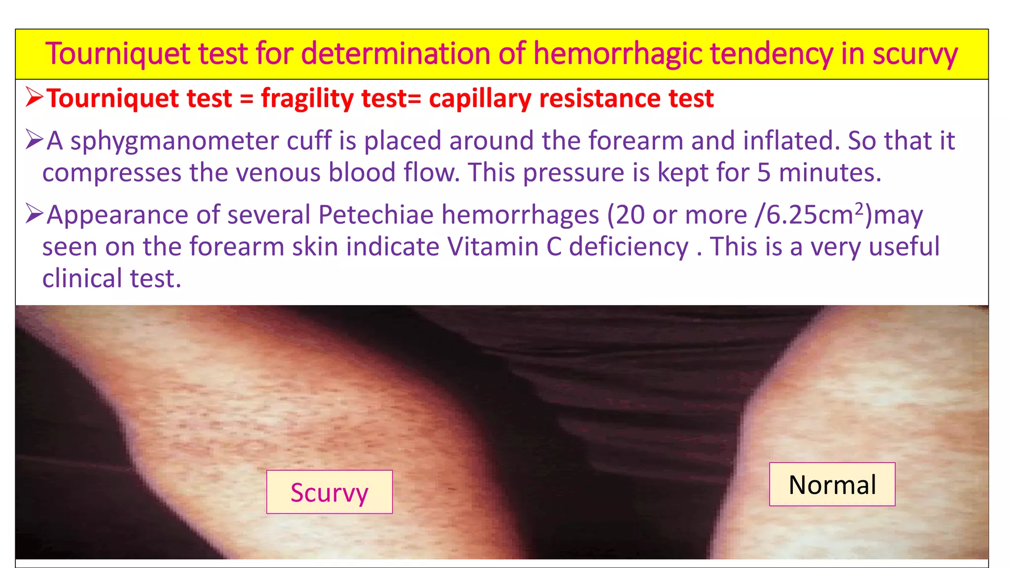 Scurvy (deficiency of vitamin C) | PDF